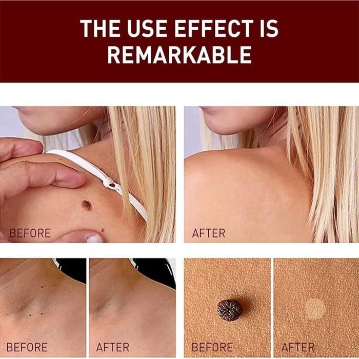 WipeOff Tags Moles Remover Wipe Off Tags Moles Remover 2023 Best