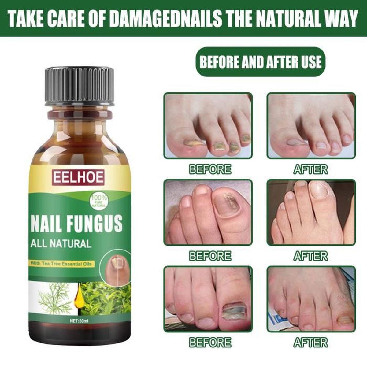 Sérum soin contre les mycoses des ongles Pour L éLimination Fongique