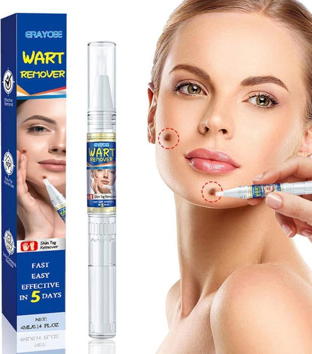 Warts and Warts Removal Pen, 2 in 1 Warts and Warts for All Skin Types ...