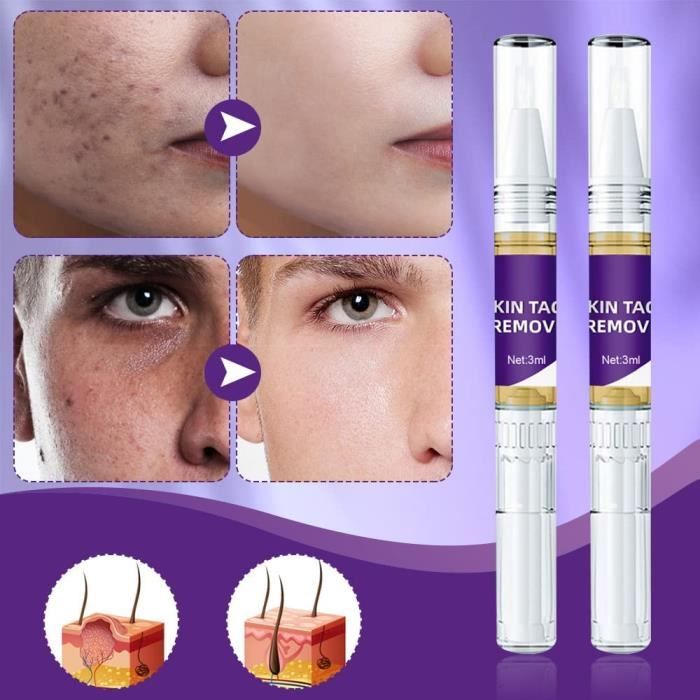 Elimination des Acrochordons, Skin Tag Remover, 2 PCS Sérum d ...