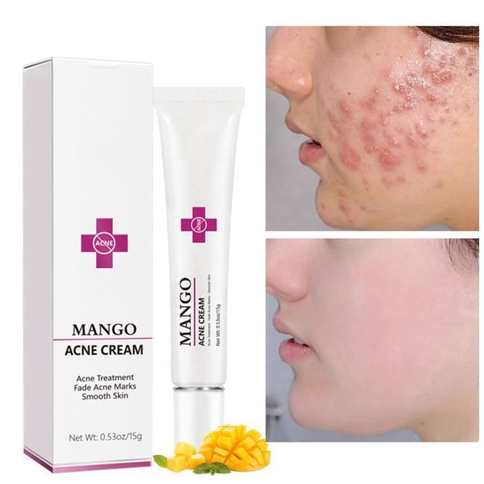 SALALIS Crème contre l'acné Crème Anti-acné, Anti-taches, cicatrices d ...