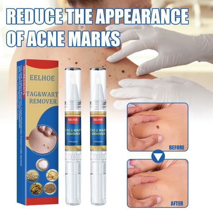 Auto Skin Tag Remover Acrochordons Traitement stylo anti-verrues ...