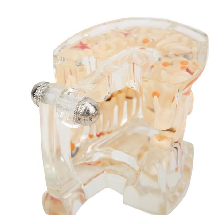 SAL modèle pathologique des dents modèle d'implant dentaire Modèles de ...