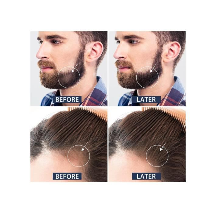 Derma Roller 0,5 mm,Dermaroller Cheveux,Roller Micro Aiguille pour ...