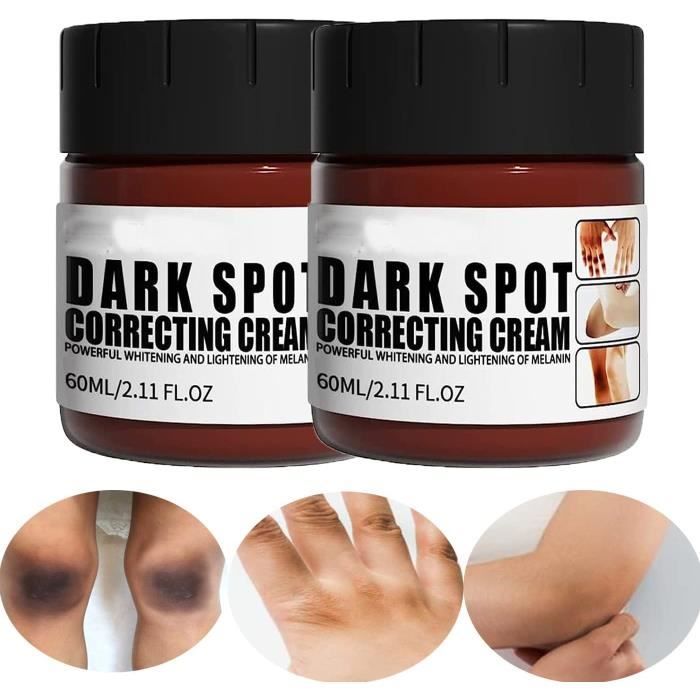 Therapy Cream,Acanthosis Nigricans Treatment Cream,Dark Knuckles ...