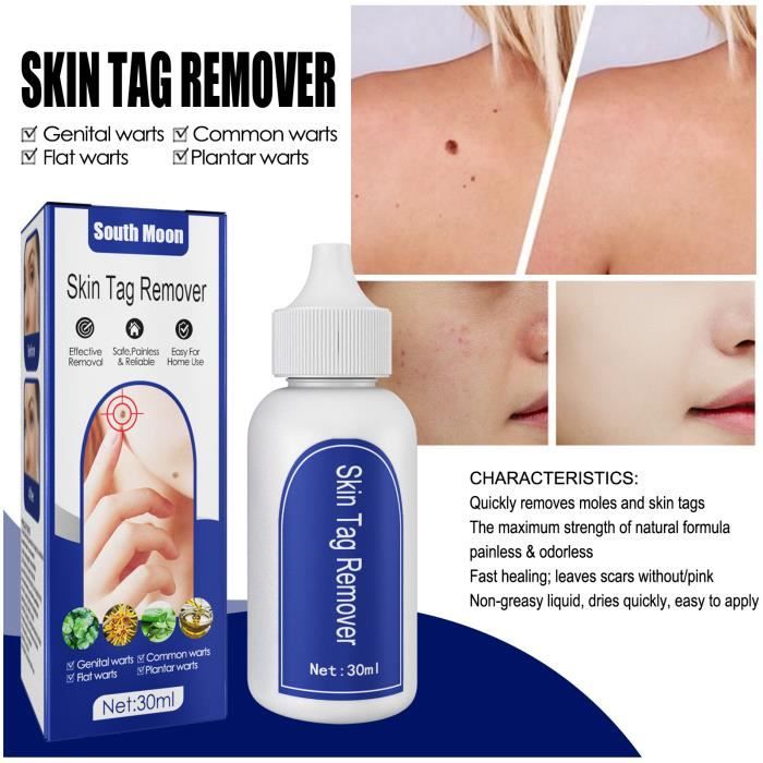 Skin tag remover,effective removal genital warts,common warts,flat ...