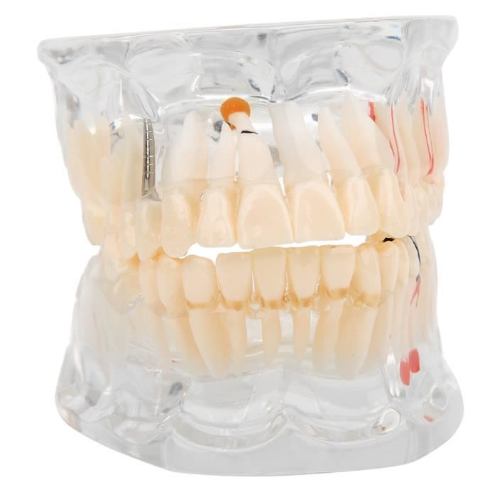 Modèle de pathologie avec dent manquante, modèle de dents dentaires ...