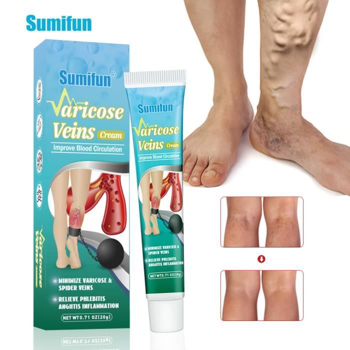 Sumifun nouvelle crème varices pour le traitement des vascularites ...