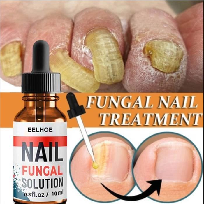 Huile De Champignon, Pour La Cuticule Des Ongles, SéRum D'éLimination ...
