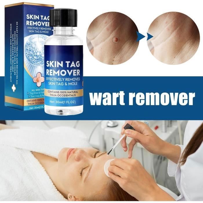 Azote Liquide Anti-verrues, Acrochordons Traitement Efficace,Sérums D ...