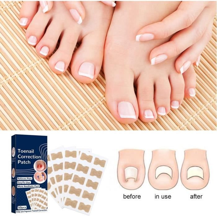 Patchs Correcteurs pour Ongles d'Orteil - TRAHOO - Lot de 50 ...