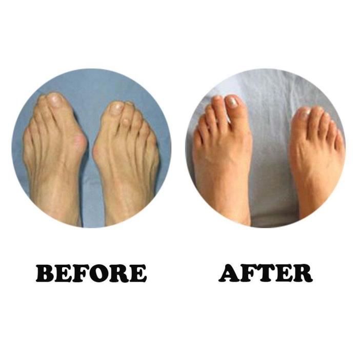 OMABETA Redresseur d'attelle d'oignon de gros orteil 1 pièces gros ...