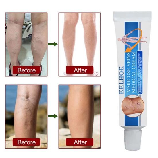 Varicose Veins Cream,Varices Crème, Spider Leg Repair Cream,Varices ...