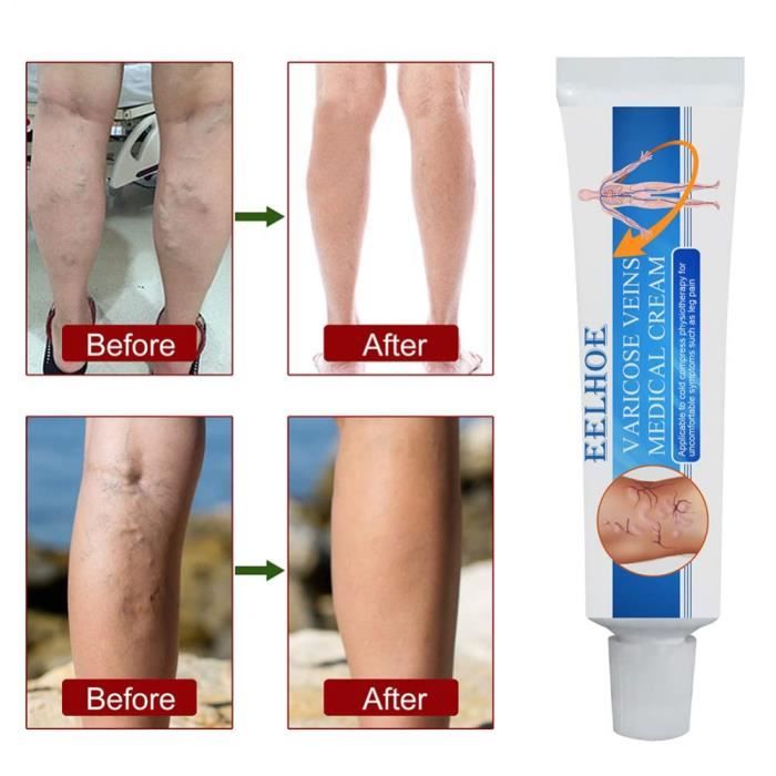 Varicose Veins Cream,Varices Crème, Spider Leg Repair Cream,Varices ...