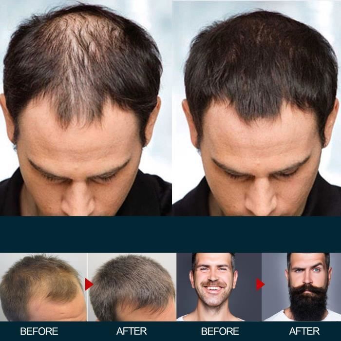 Hair Regen Advanced Hair Regrowth Treatment for Men , Hair Loss ...