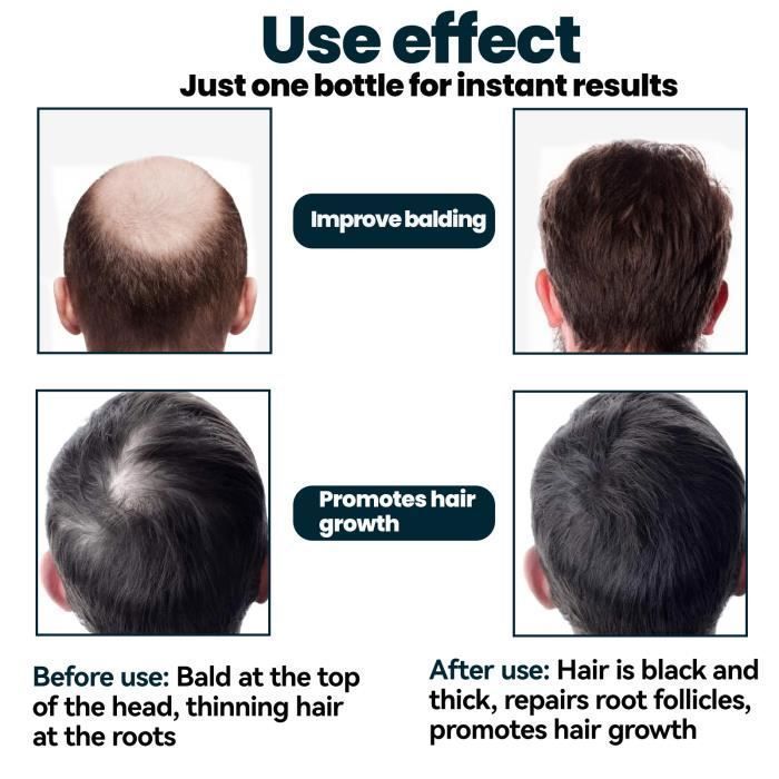 Hair Regen Advanced Hair Regrowth Treatment for Men , Hair Loss ...