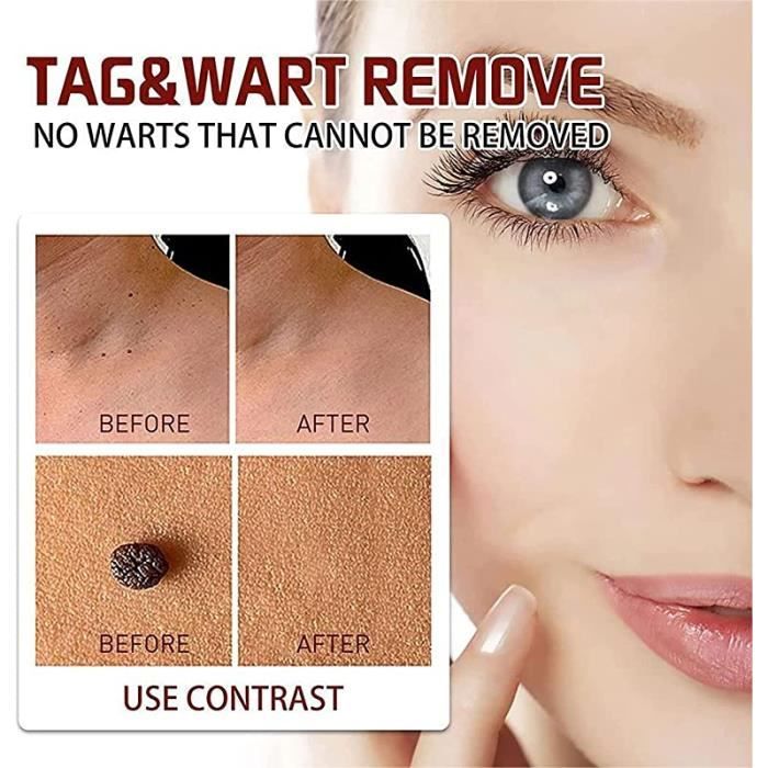 Wipeoff Tags Moles Remover, Wipe Off Tags and Mole Remover, Extreme ...