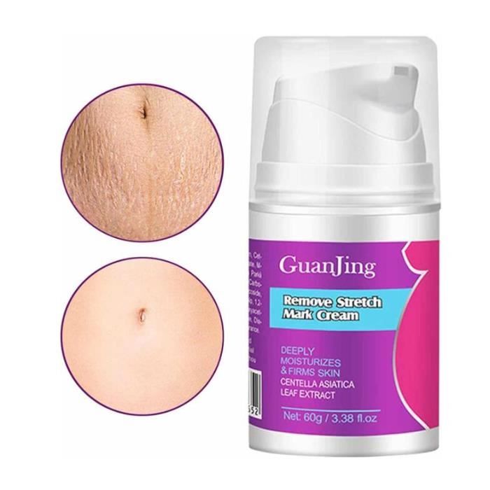 Crème Vergetures Grossesse,Crème anti-cicatrices pour les vieilles ...