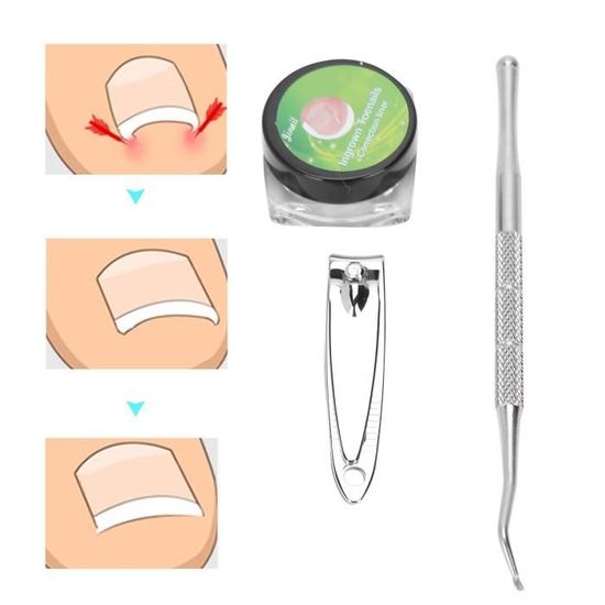 VGE Correcteur d'ongle incarné Kit de correction d'oignons Soins des ...