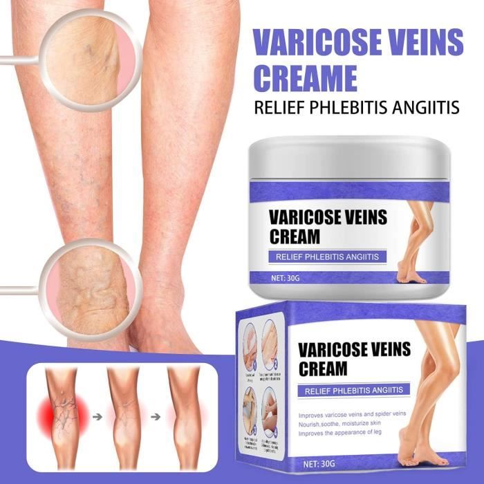 Varices Traitement Jambe Crème Cream Varices Soulager rapidement les ...