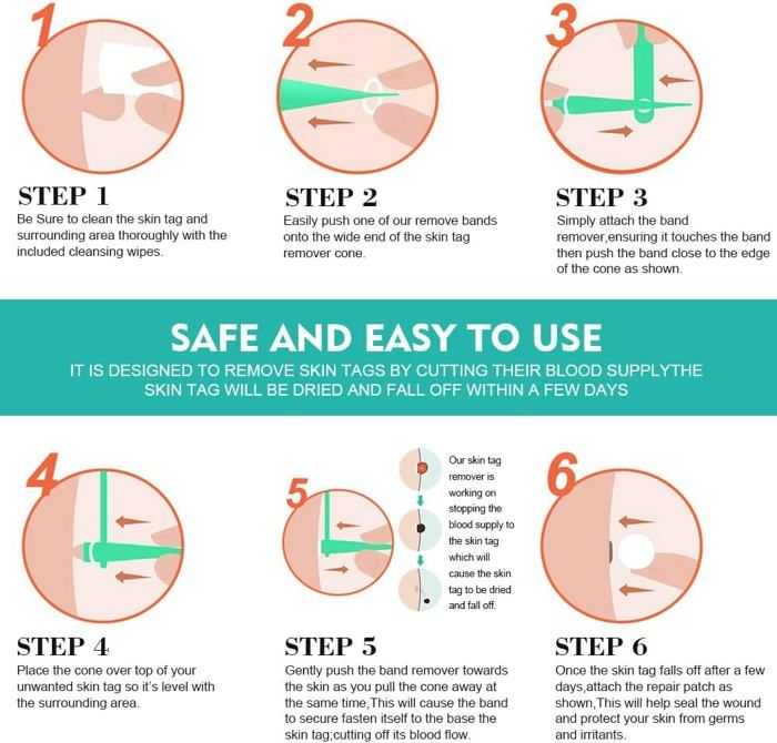 Kit de Acrochordons Traitement, Traitement anti Acrochordons avec 30 ...