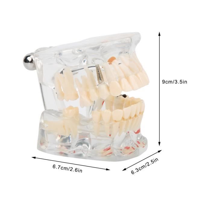 Modèle de pathologie, modèle de dents, standard transparent avec résine ...