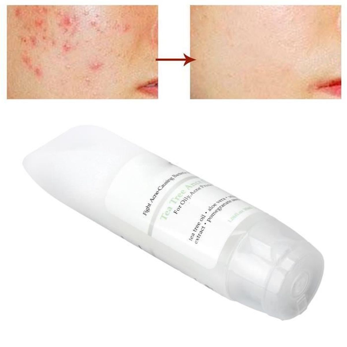 30 ml crème anti-acné crème pour les boutons crème hydratante pour le ... 30 ml crème anti-acné crème pour les boutons crème hydratante pour le ...