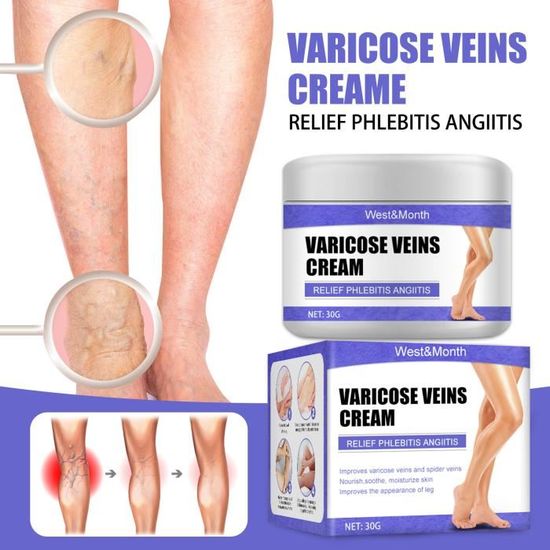 Crème anti-varices efficace 30g, soulage la vascularite, phlébite ...