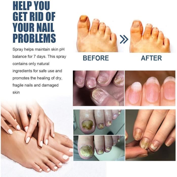 3 Pcs Furzero Spray pour Le Traitement des Pieds des Athlètes, Furzero ...