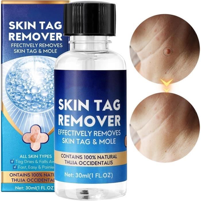 Azote Liquide Anti-verrues - Verrue Traitement Efficace | Traitement ...