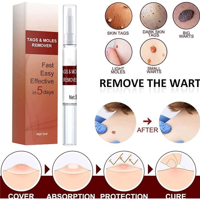 Wipeoff Tags And Moles Remover Wipe Off Tags And Mole Remover Extreme Skin Tag Wipe Off Tags