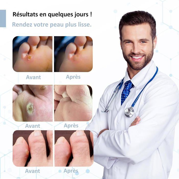 Homopathie Pour Verrue Plantaire