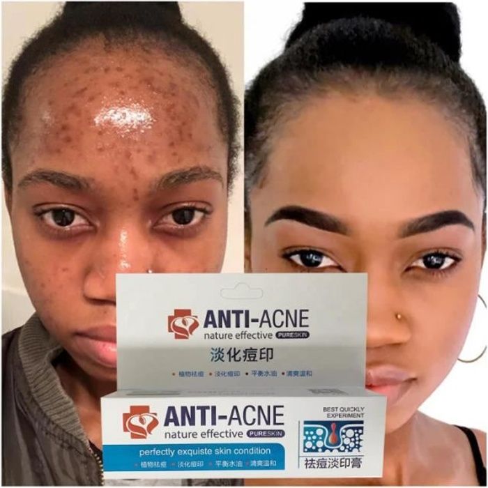 3 pièces - Crème anti acné efficace, élimine les imperfections, Les ...