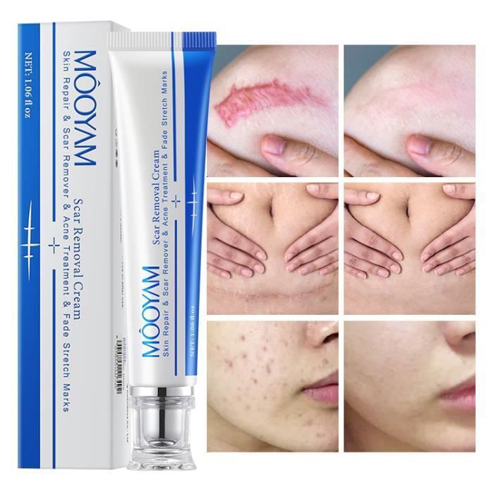 MOOYAM Herbal Scar Removal Cream Gel Repair Pock Mark Burn Cicatrice ...