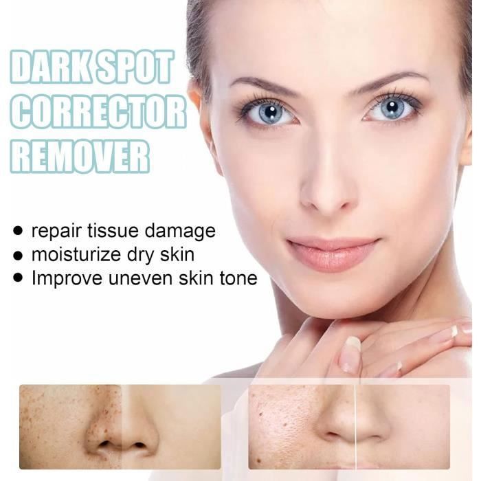 Crème Anti - Taches Noires, Crème Anti - Taches Pigmentaires,Crème Anti - Taches Noires, Crème ...